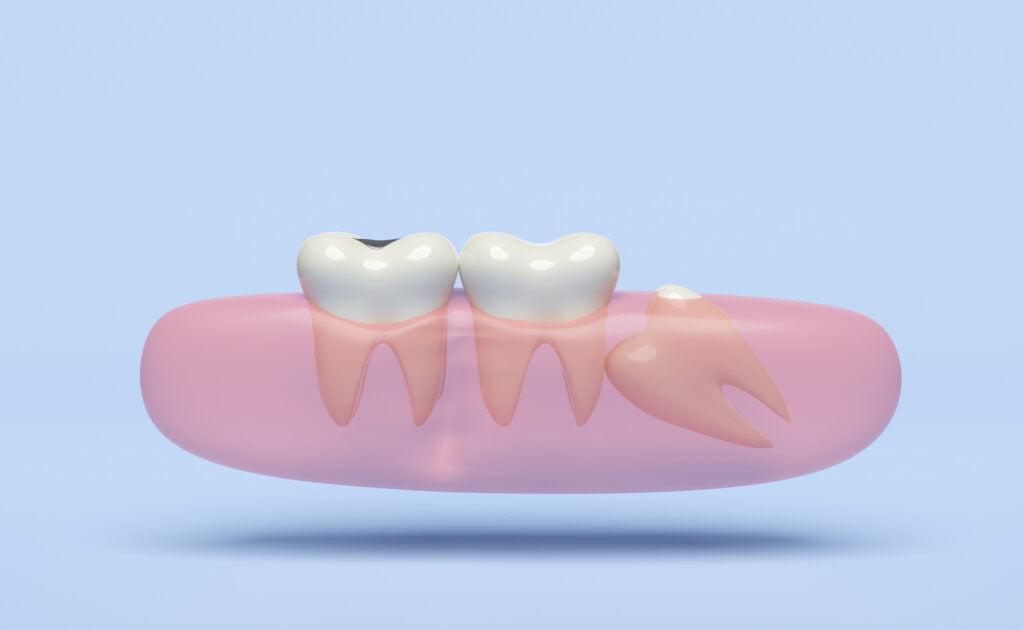 Everything you Need to Know About Wisdom Teeth
